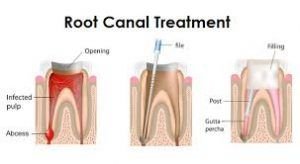 Root Canal Therapy and Dental Crown : Why Cap Necessary After RCT