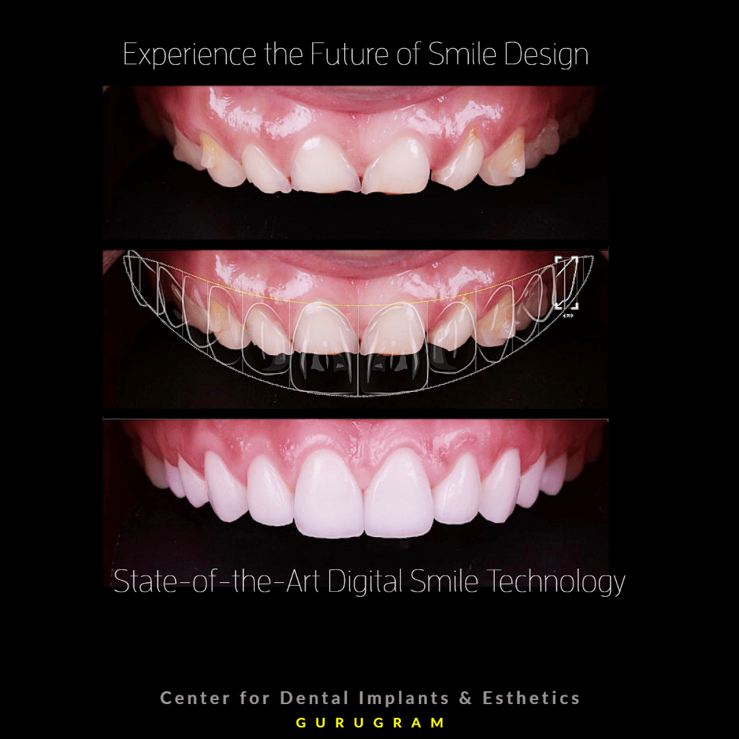 Porcelain Veneers Cost : Transform Your Smile Porcelain Veneers Cost : Transform Your Smile