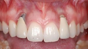 How to Fix Failed Dental Implant : A Comprehensive Guide 🦷